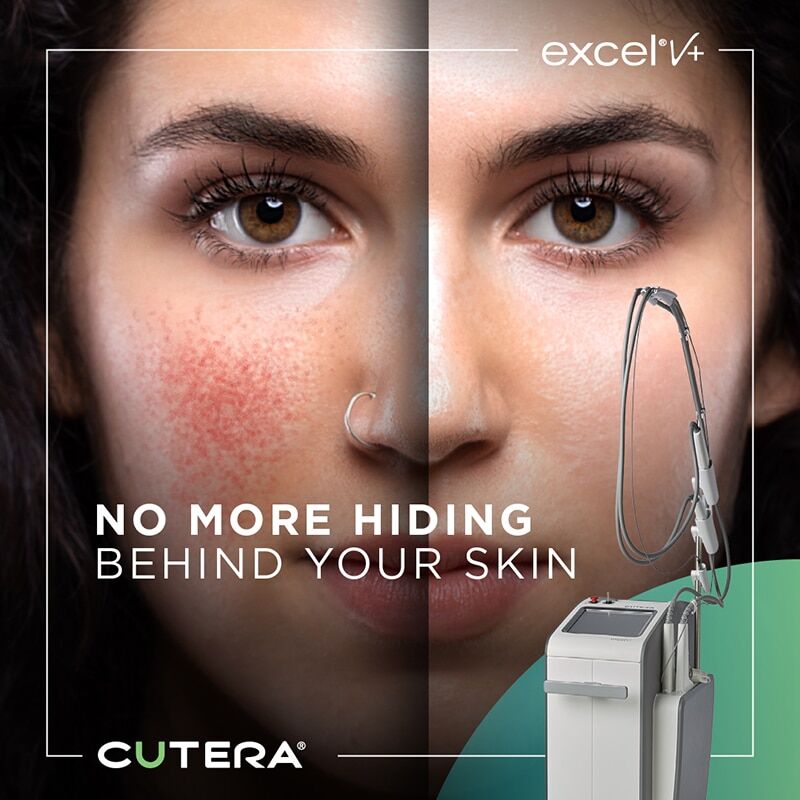 Vascular Treatments | Devoted Skin & Beauty